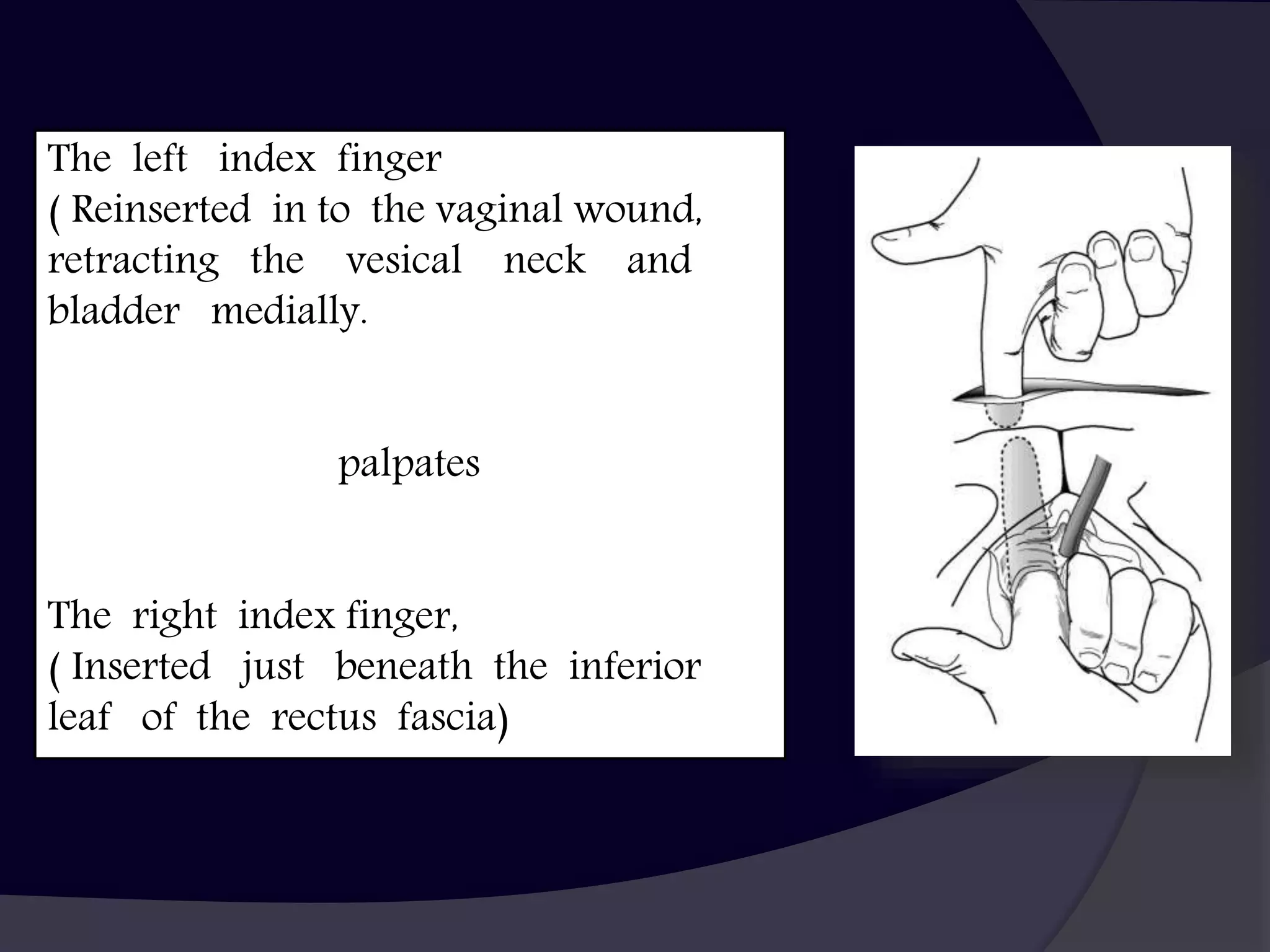 Vaginal approach for Stress Urinary Incontinence surgery | PPT