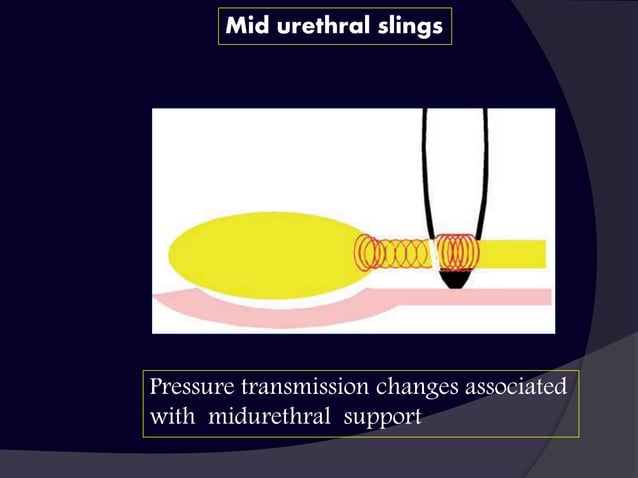 Vaginal approach for Stress Urinary Incontinence surgery | PPT