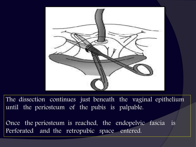 Vaginal approach for Stress Urinary Incontinence surgery | PPT