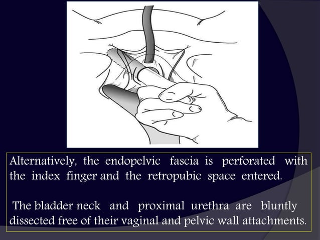 Vaginal approach for Stress Urinary Incontinence surgery | PPT