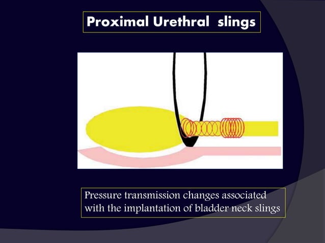 Vaginal approach for Stress Urinary Incontinence surgery | PPT