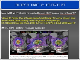 IMRT IN CANCER CERVIX | ODP