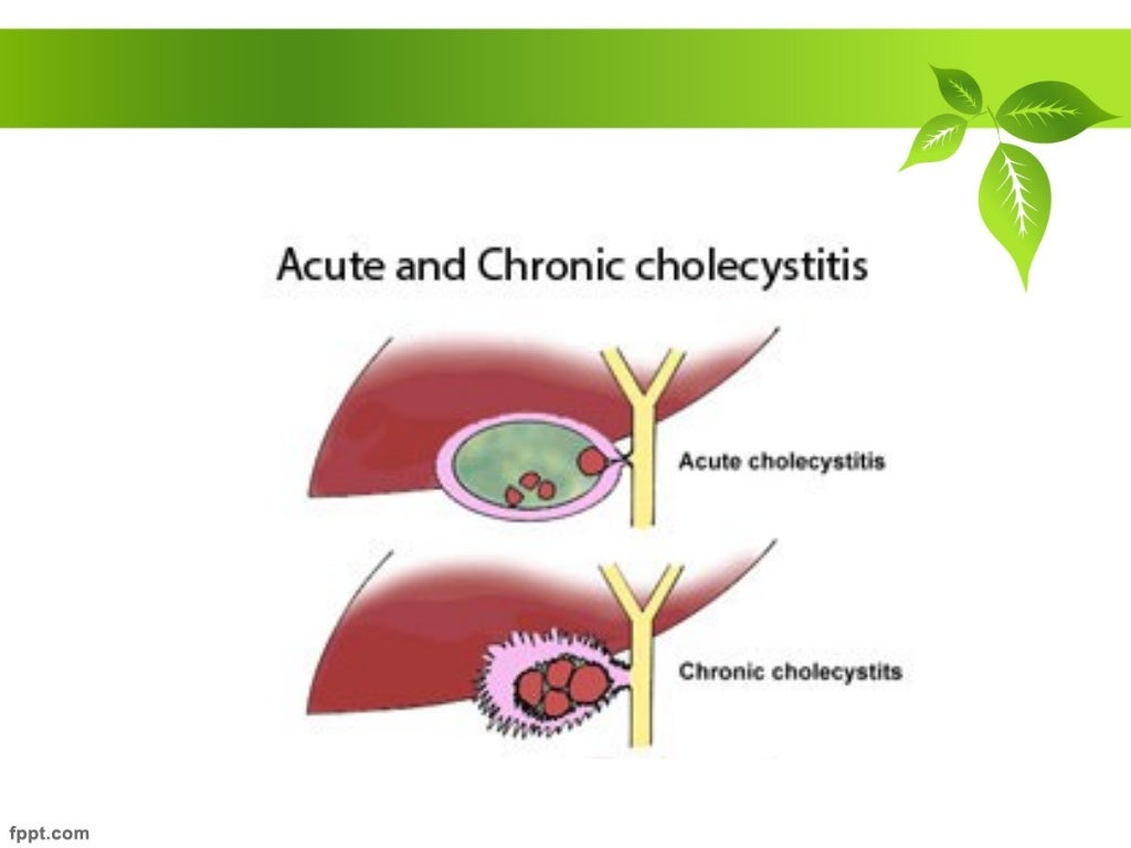 Acute and Chronic Cholecystitis