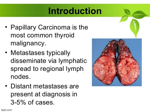 A Case Of Papillary Carcinoma Thyroid With Hematogenous Spread