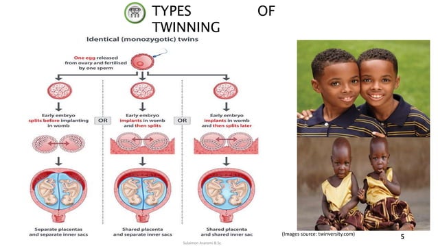 Concept of Twinning/multiple birth | PPTX