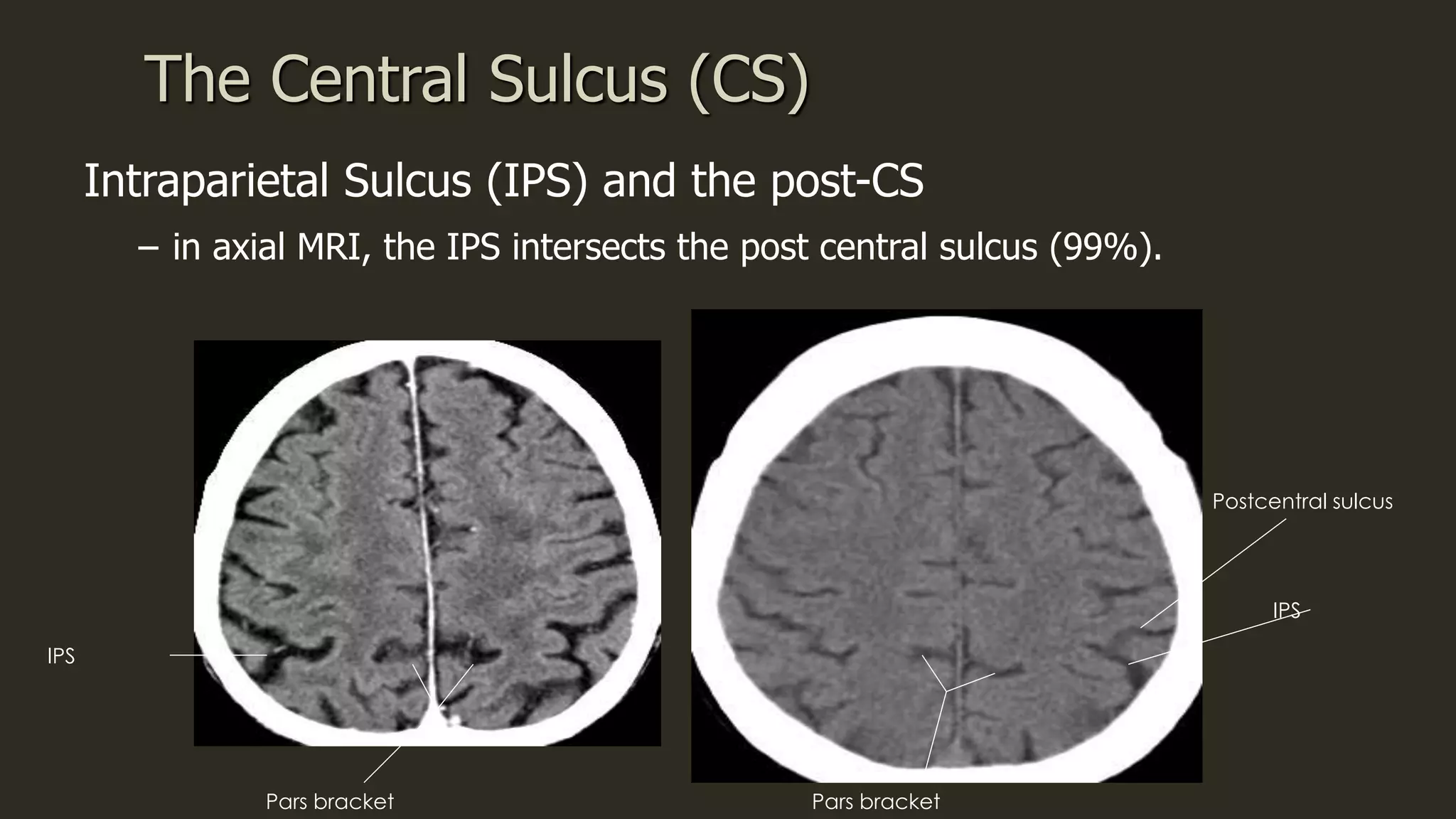 Sulcal anatomy supratentorial brain, excluding the temporal lobe. | PPTX