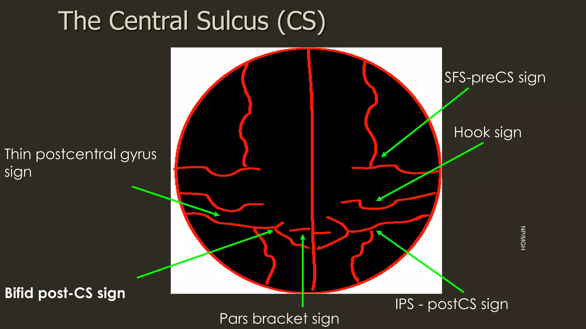 Sulcal anatomy supratentorial brain, excluding the temporal lobe. | PPTX