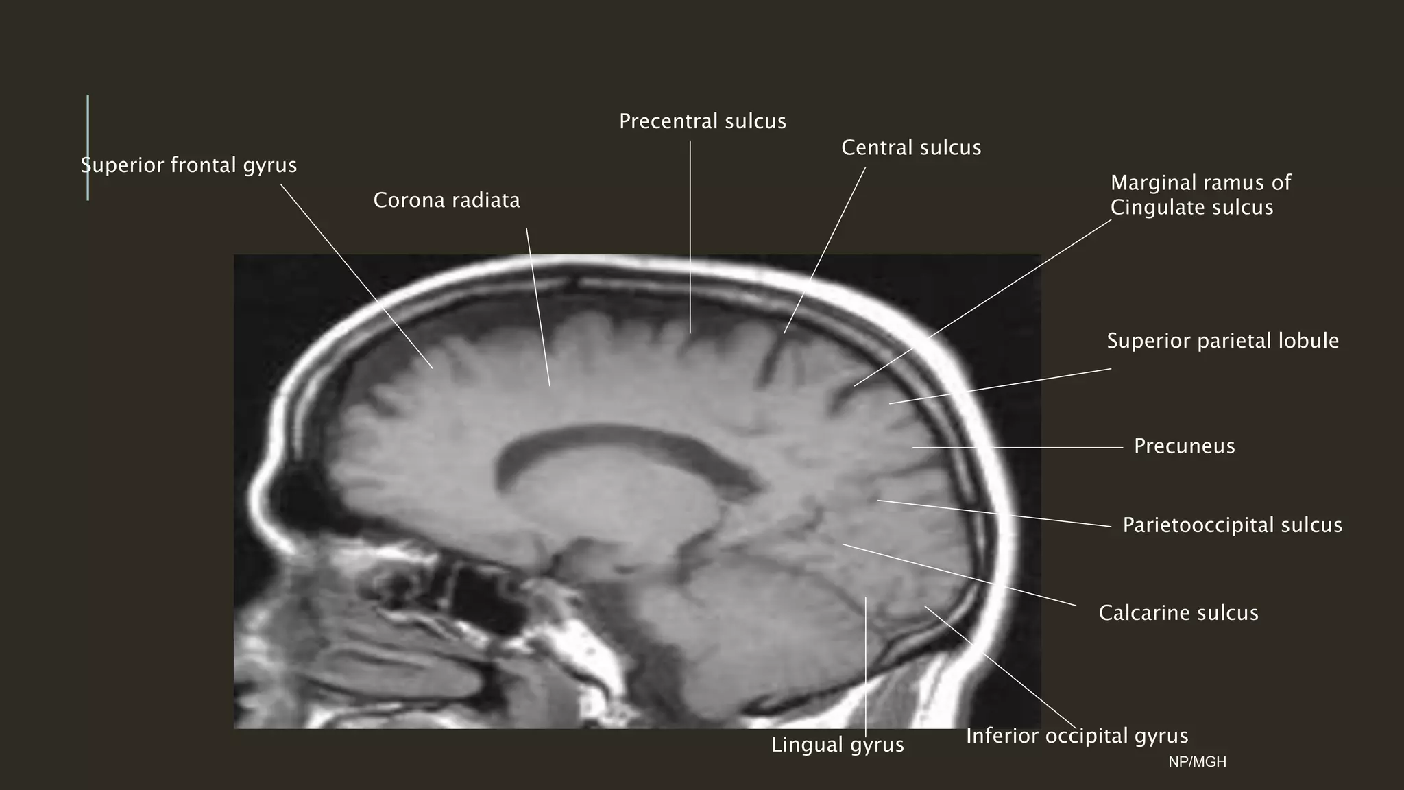 Sulcal anatomy supratentorial brain, excluding the temporal lobe. | PPTX