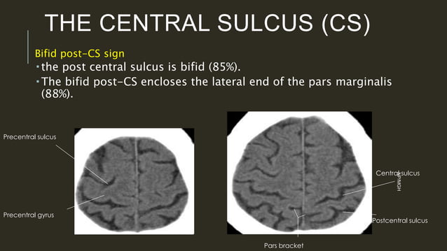 Sulcal anatomy supratentorial brain, excluding the temporal lobe. | PPTX