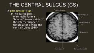 Sulcal anatomy supratentorial brain, excluding the temporal lobe. | PPT