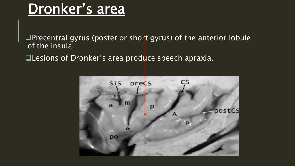 Sulcal anatomy supratentorial brain, excluding the temporal lobe.