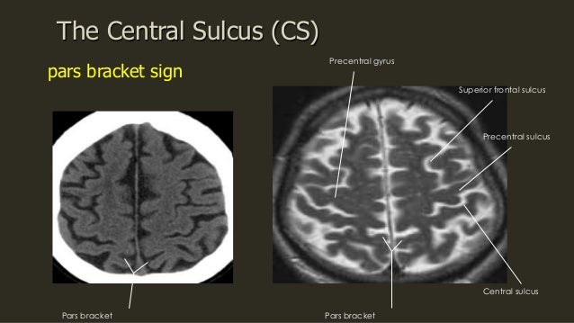 Sulcal anatomy supratentorial brain, excluding the temporal lobe.