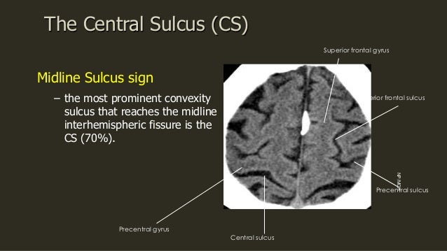Sulcal anatomy supratentorial brain, excluding the temporal lobe.