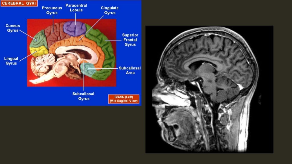 Sulcal anatomy supratentorial brain, excluding the temporal lobe.
