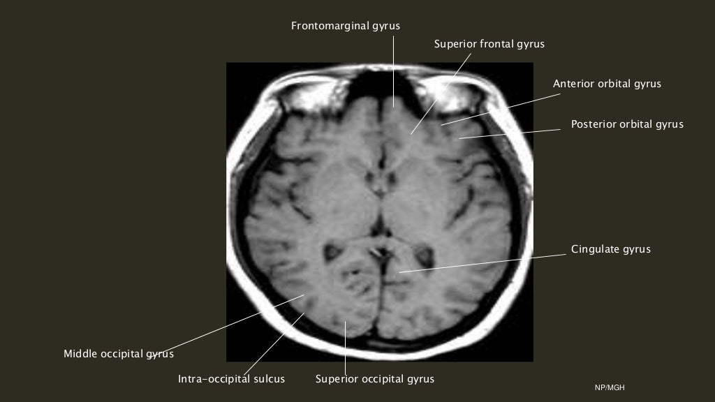 Sulcal anatomy supratentorial brain, excluding the temporal lobe.