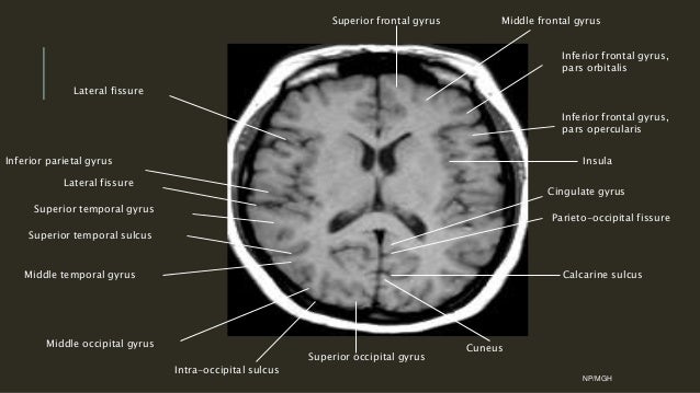 Sulcal anatomy supratentorial brain, excluding the temporal lobe.
