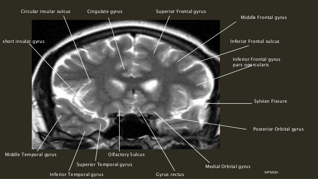 Sulcal anatomy supratentorial brain, excluding the temporal lobe.
