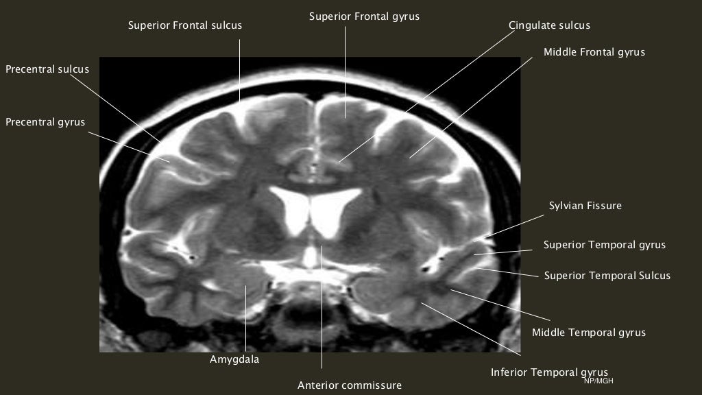 Sulcal anatomy supratentorial brain, excluding the temporal lobe.