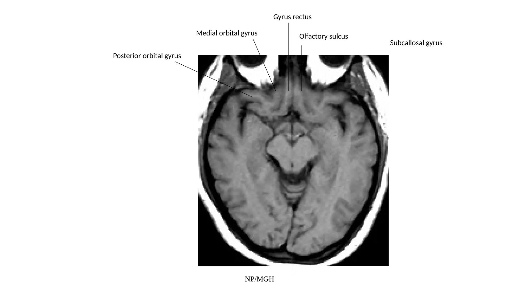 Sulcal and gyral of brain radioanatomy. | PPTX