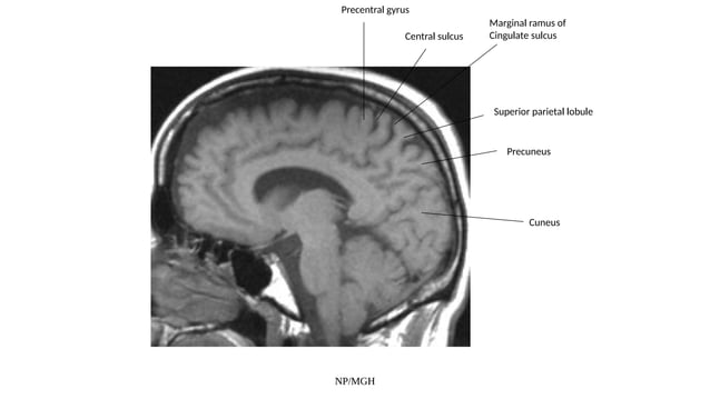 Sulcal and gyral of brain radioanatomy. | PPTX