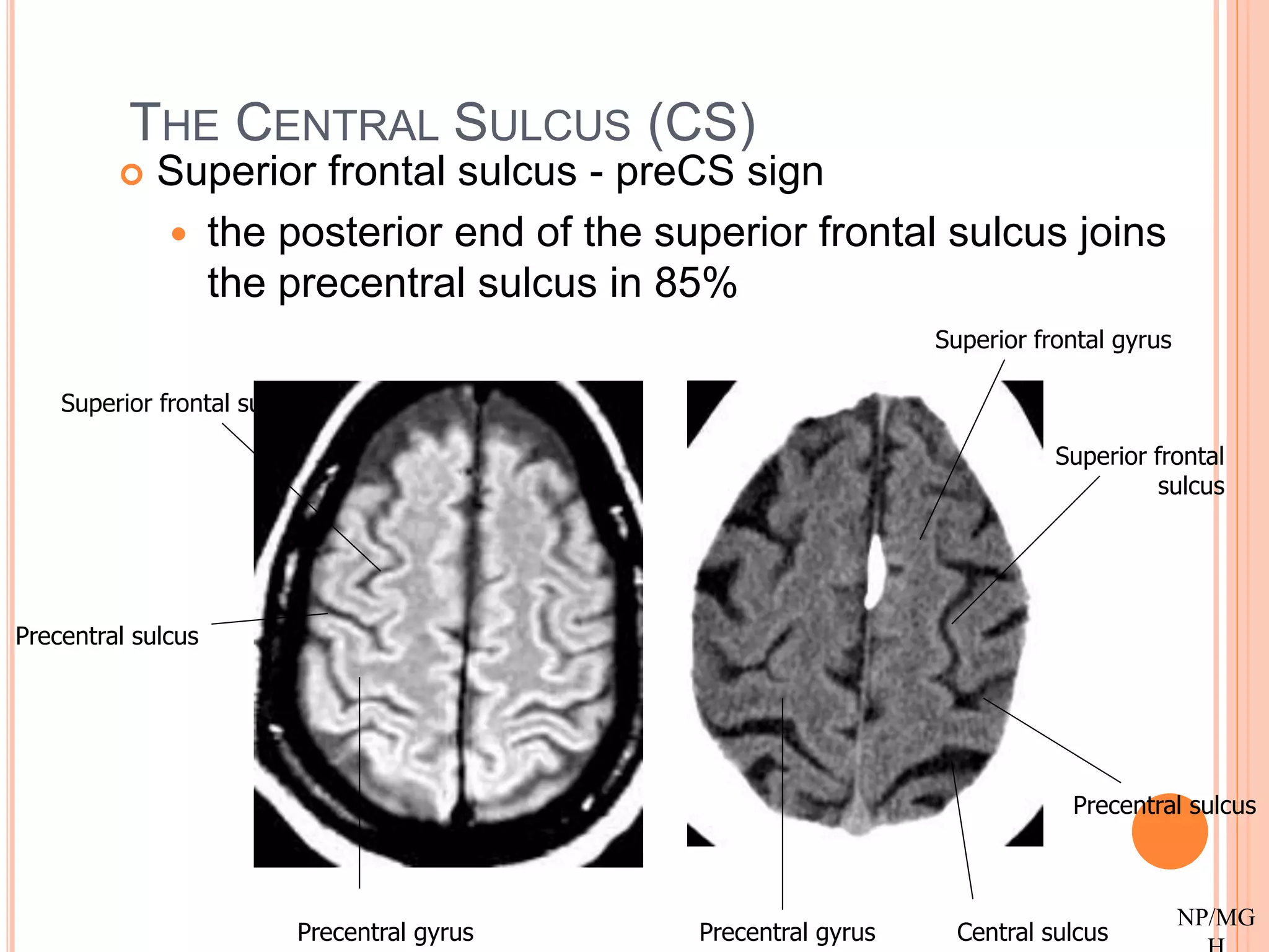 Sulcal and gyral neuroanatomy | PPTX | Brain and Nervous System ...