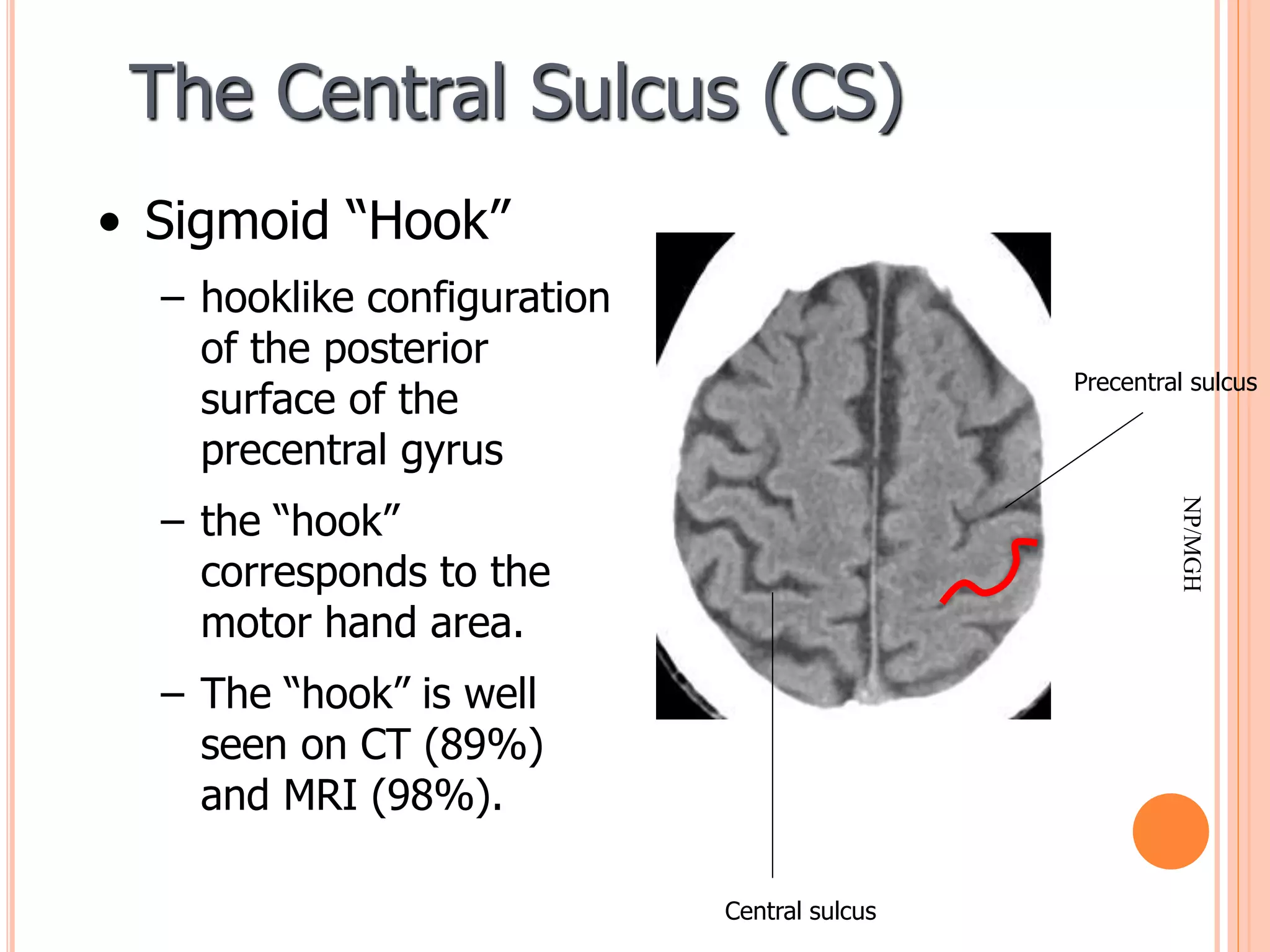 Sulcal and gyral neuroanatomy | PPTX