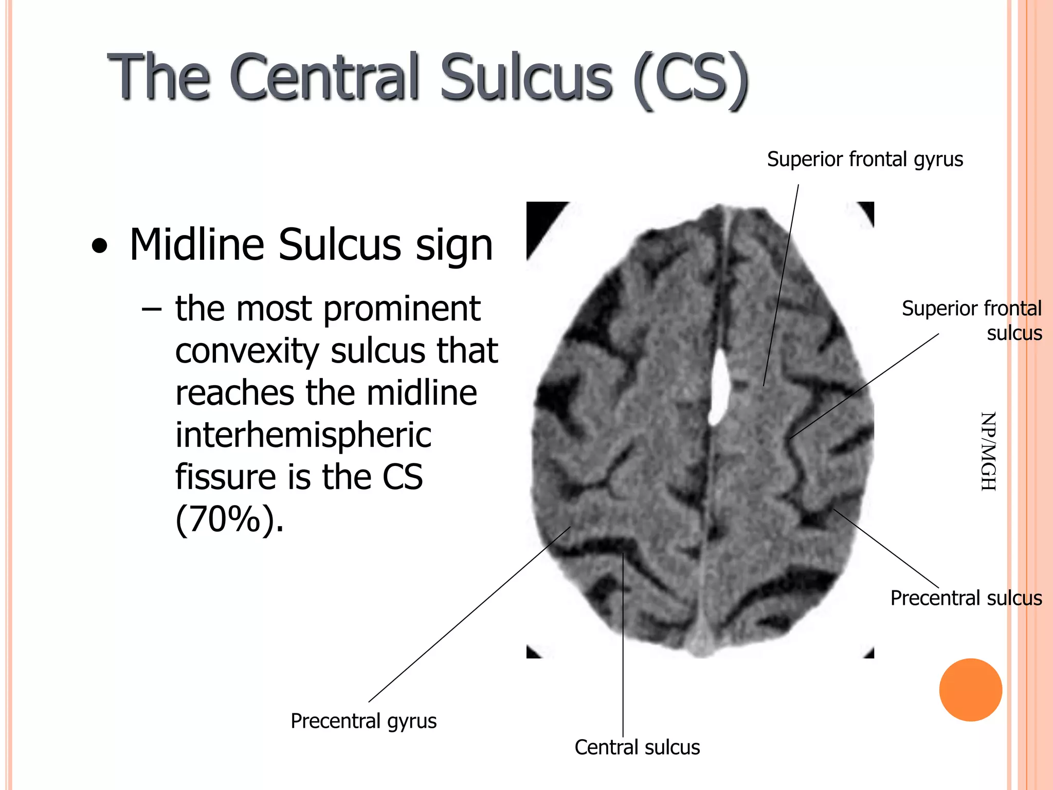 Sulcal and gyral neuroanatomy | PPTX