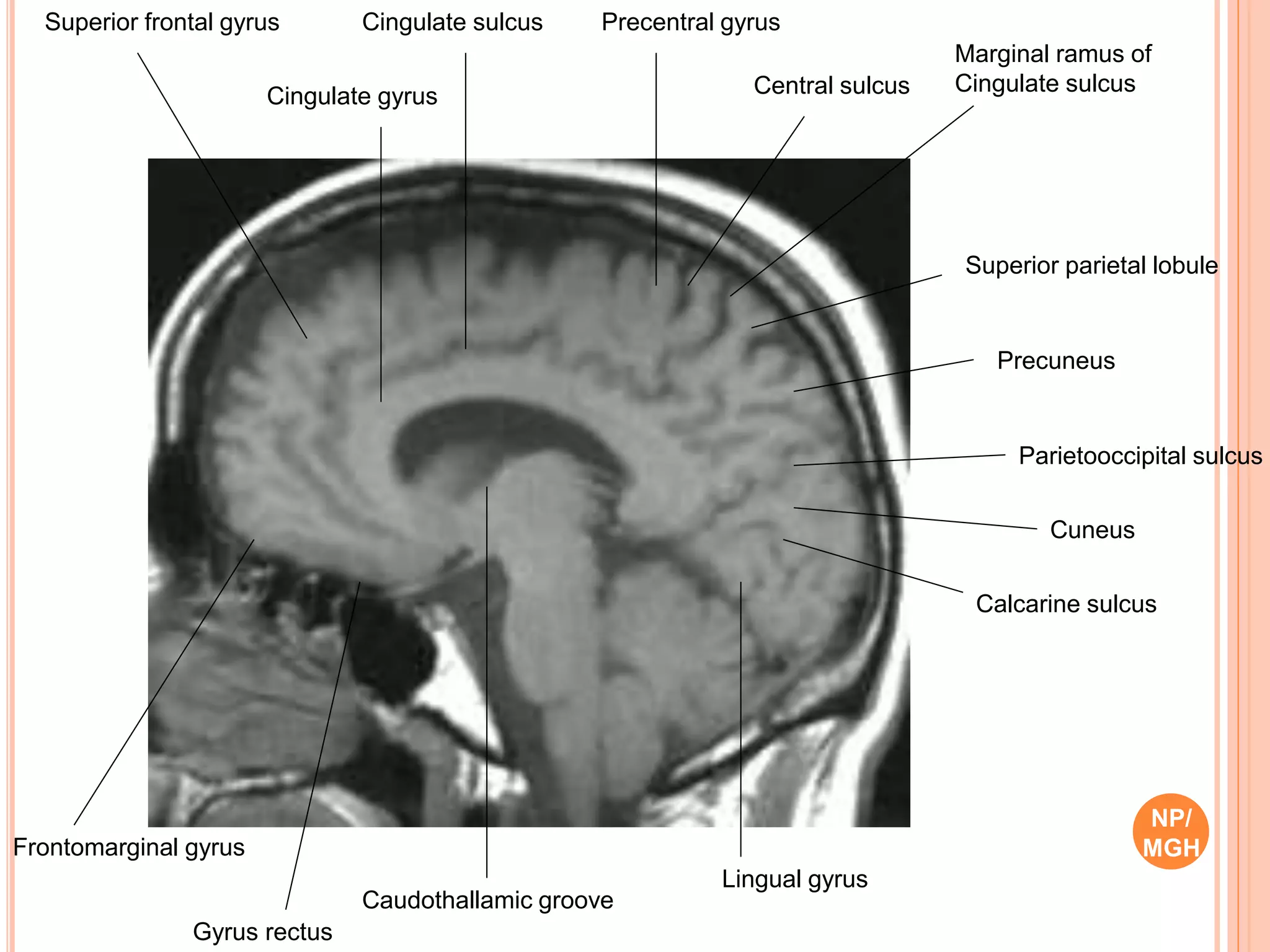 Sulcal and gyral neuroanatomy | PPTX