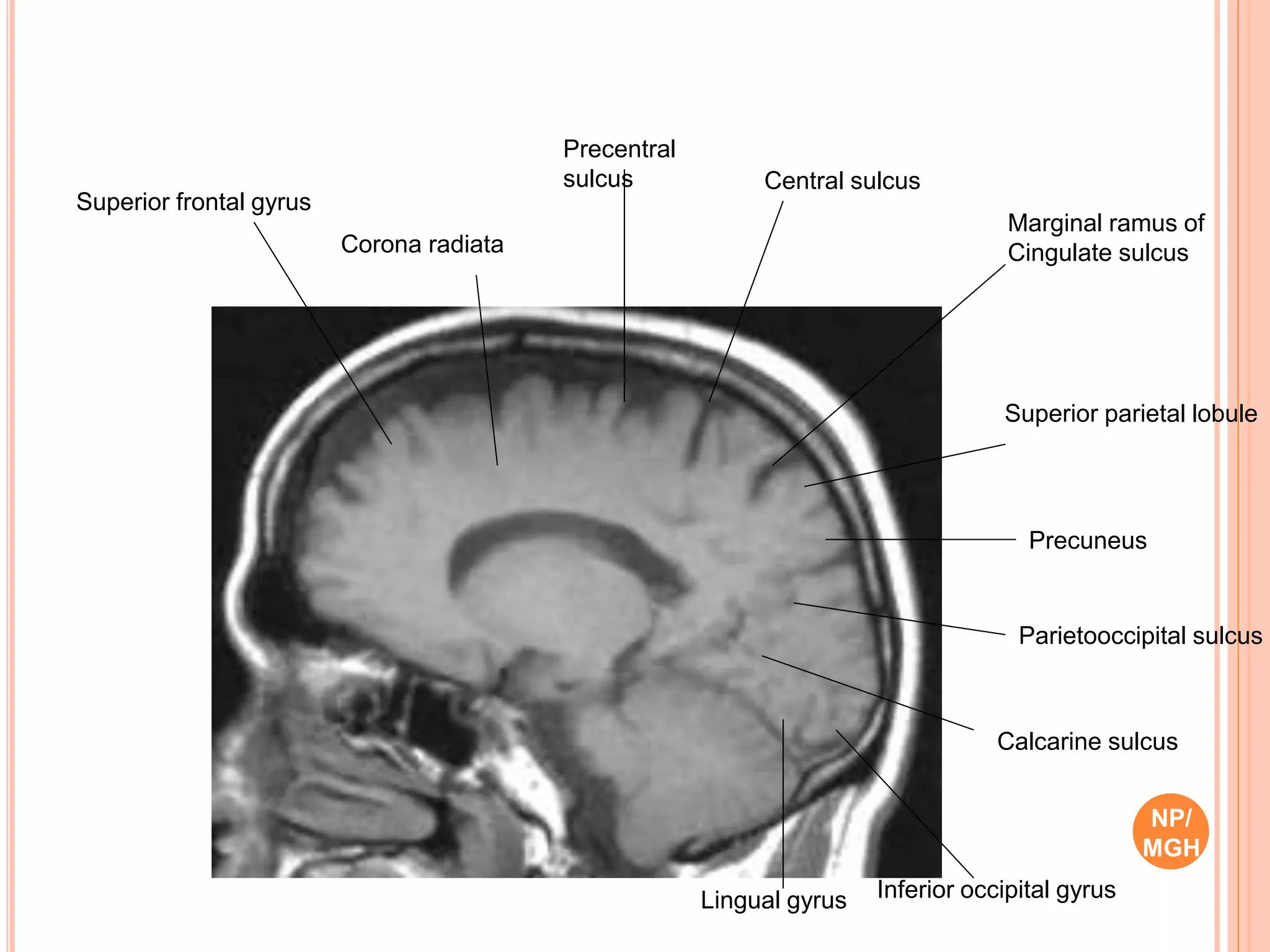 Sulcal and gyral neuroanatomy | PPTX