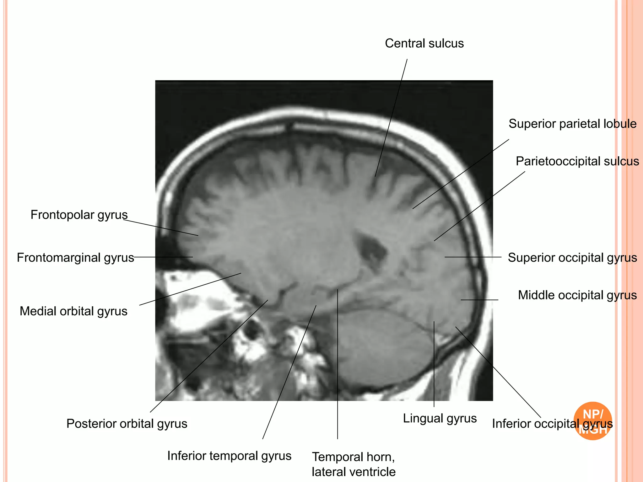 Sulcal and gyral neuroanatomy | PPTX