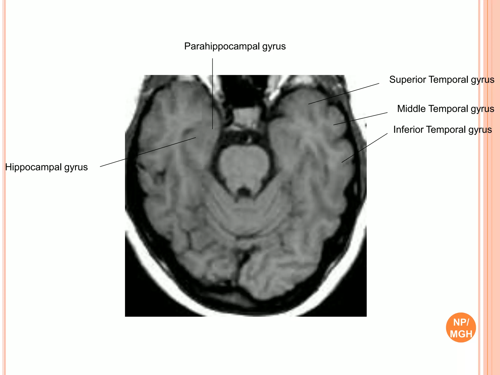 Sulcal and gyral neuroanatomy | PPTX