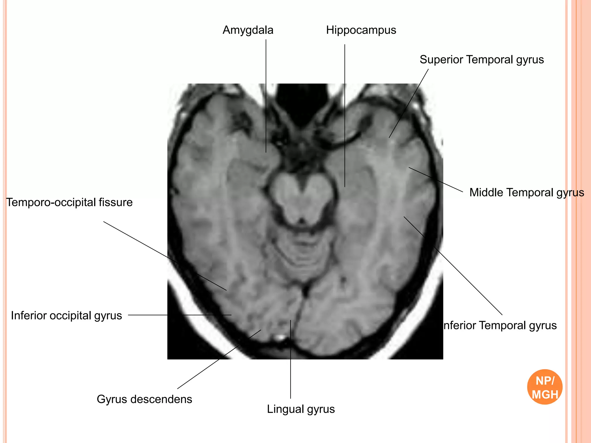 Sulcal and gyral neuroanatomy | PPTX