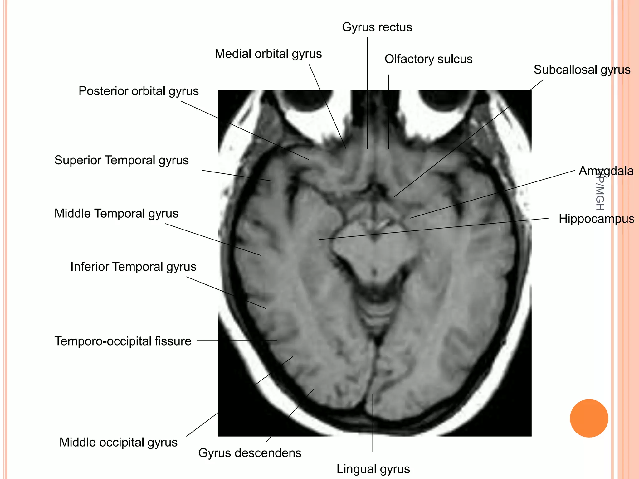 Sulcal and gyral neuroanatomy | PPTX