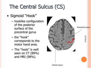 Sigmoid Sulcus