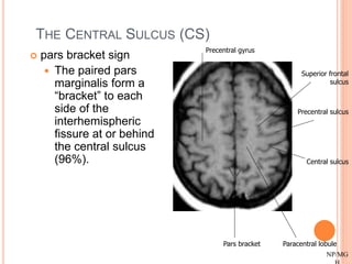 Sulcal and gyral neuroanatomy | PPT