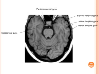 Parahippocampal Gyrus Mri