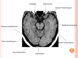 Parahippocampal Gyrus Mri