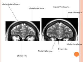 Superior Frontal Gyrus Mri