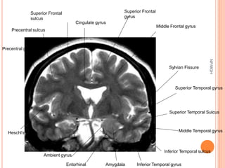 Angular Gyrus Mri