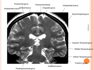 Parahippocampal Gyrus Mri