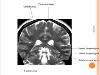 Mri Paracentral Lobule