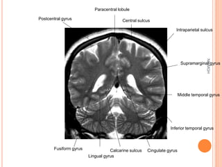 Superior Frontal Gyrus Mri