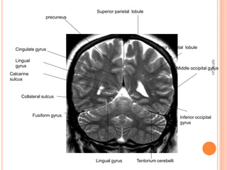 Angular Gyrus Mri