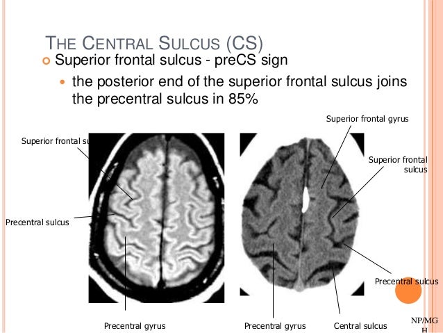Sulcal and gyral neuroanatomy