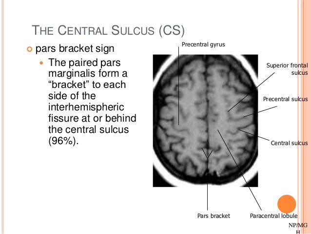 Sulcal and gyral neuroanatomy