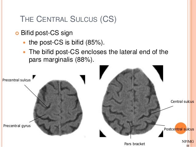 Sulcal and gyral neuroanatomy