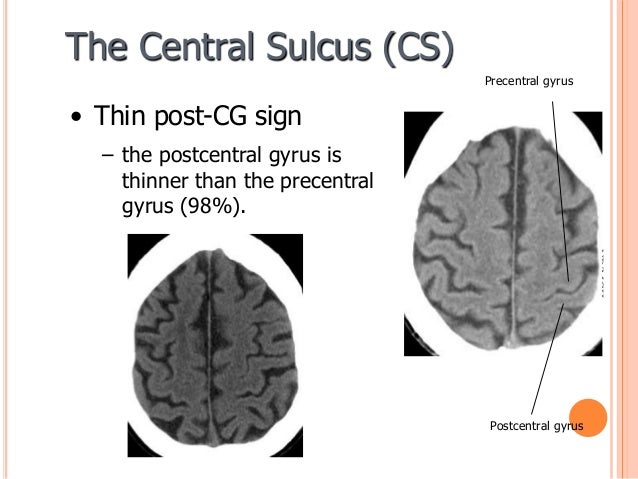 Sulcal and gyral neuroanatomy