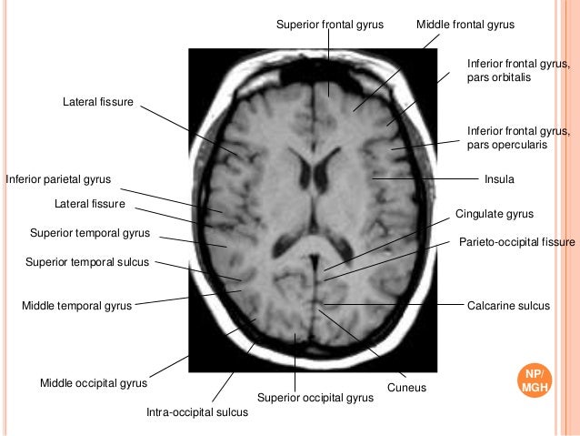 Sulcal and gyral neuroanatomy