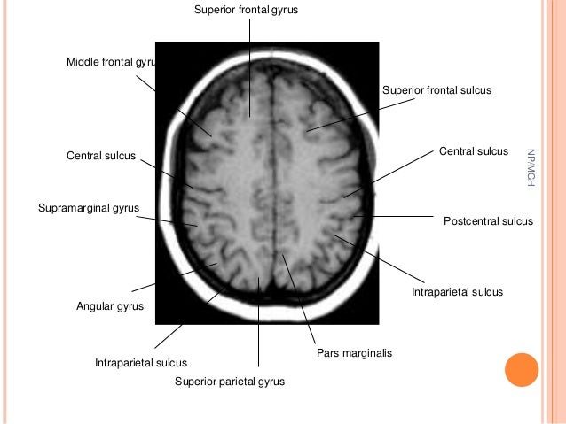 Sulcal and gyral neuroanatomy