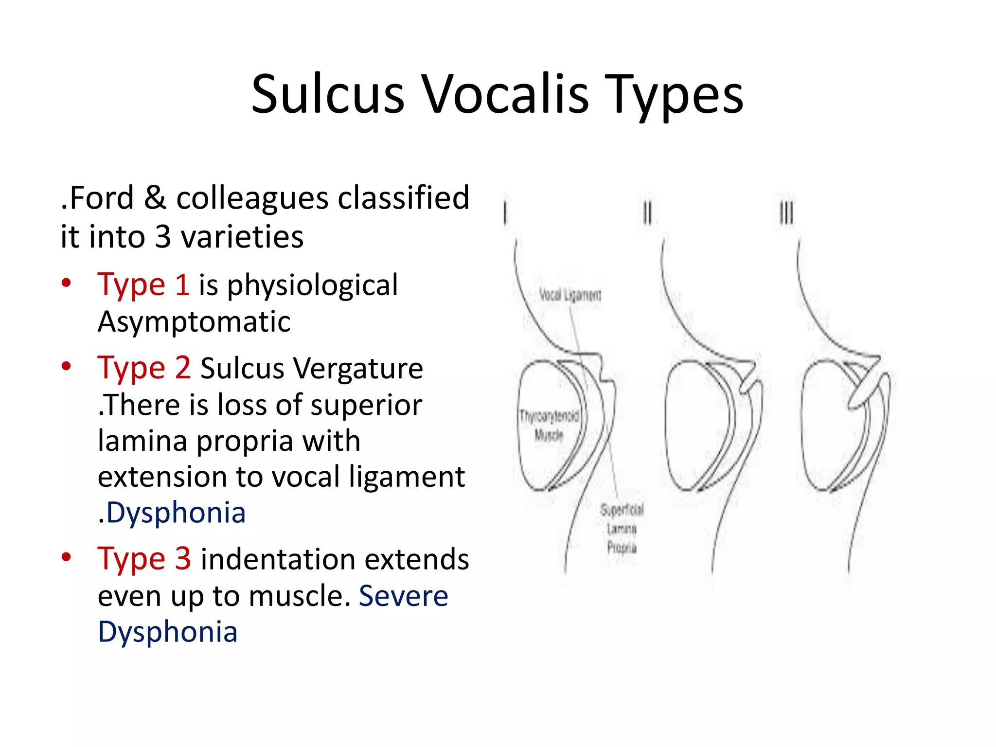 Sulcus vocalis | PPTX